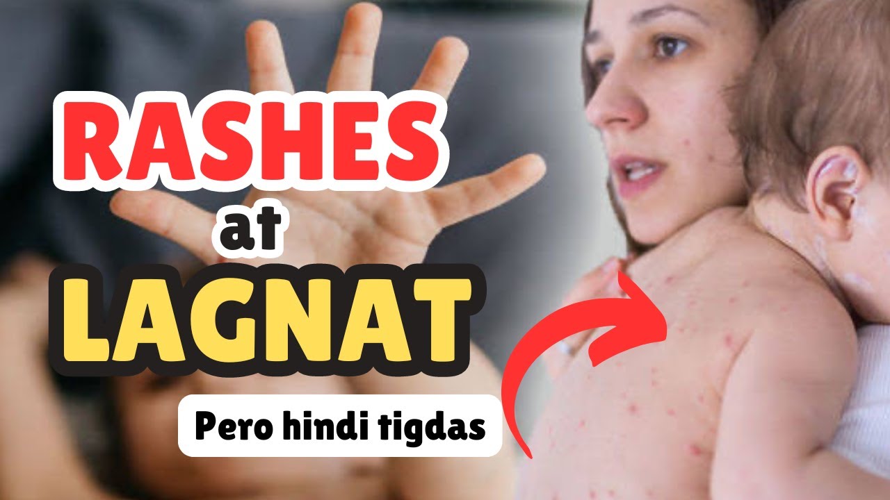 RASHES at LAGNAT sa bata pero hindi TIGDAS|ANO GAGAWIN|Dr. PediaMom ...