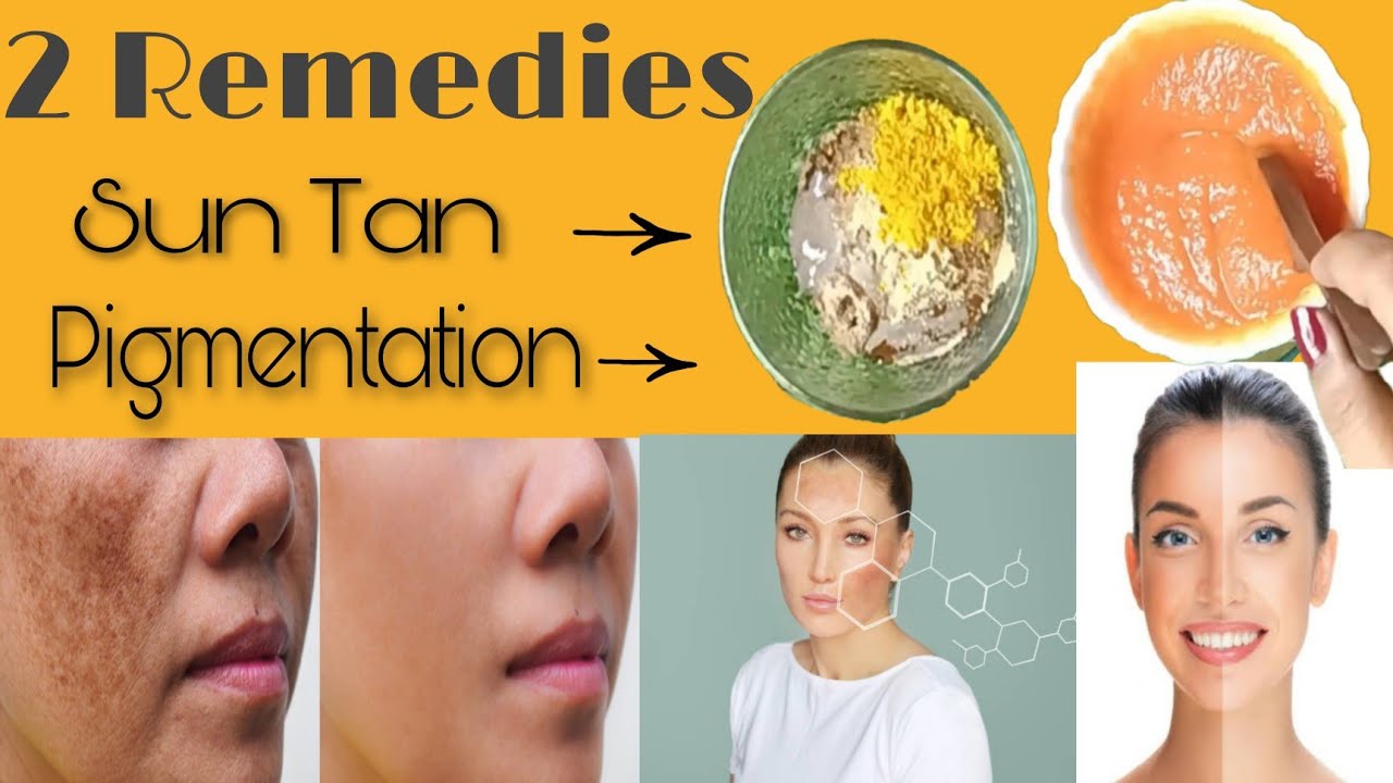 How to get rid of pigmentation & Sun-Tan/ 2 Remedies in 1 video/ Get ...
