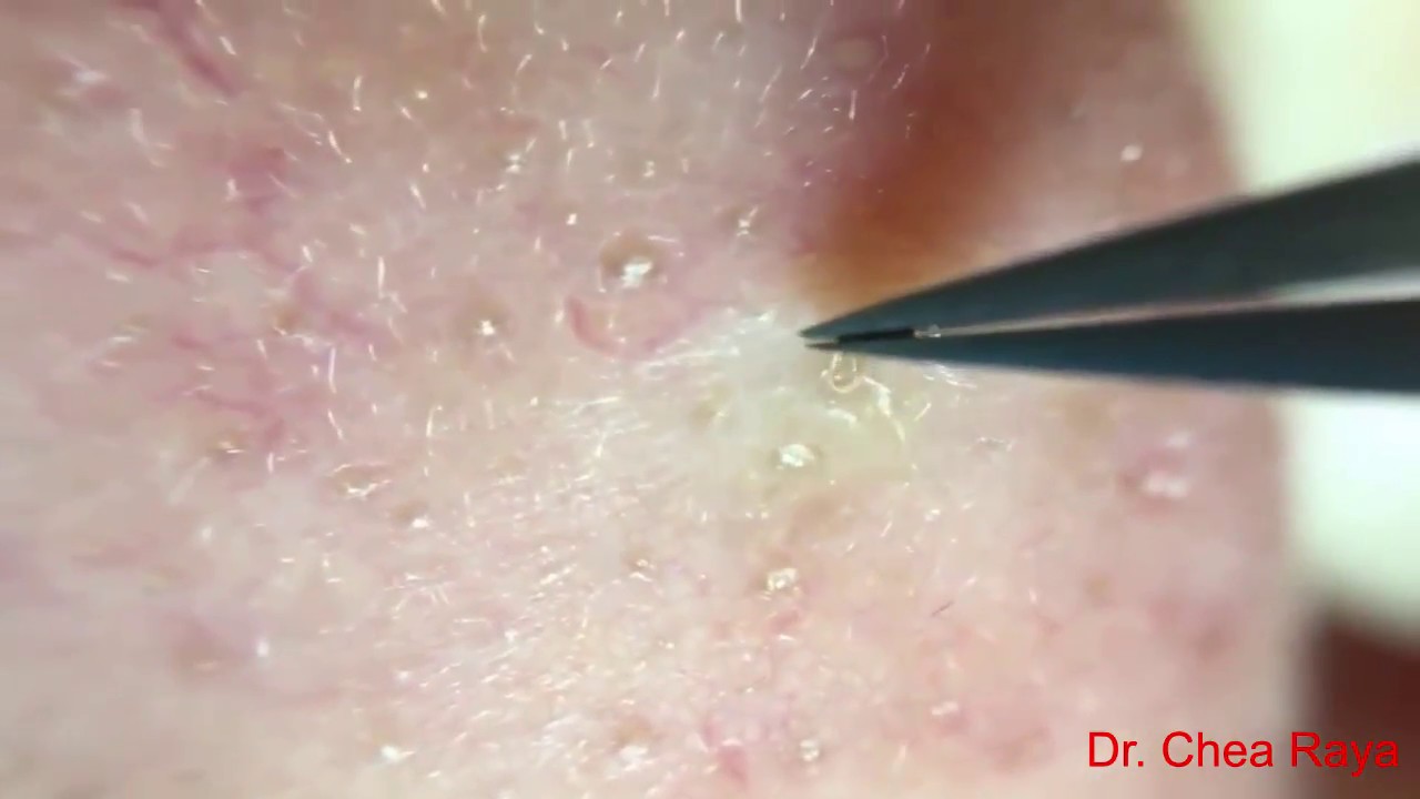 Cystic Acne │Pimples & Blackheads Extraction On Face Acne Treatment ...