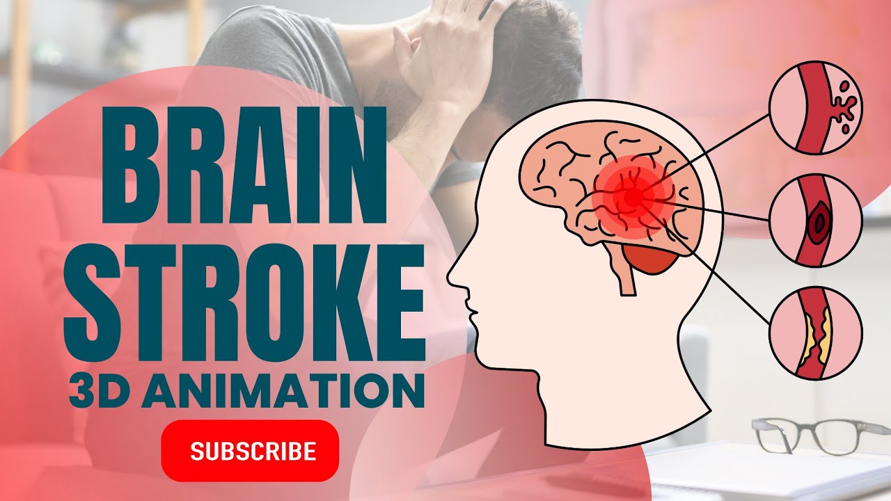What Causes a Brain Stroke? | Brain Attack 3D Animation & Treatment ...