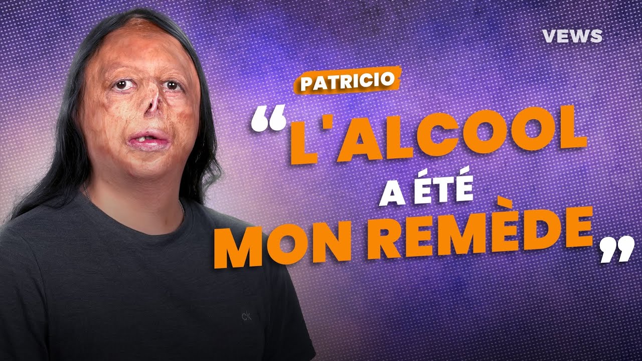 Patricio, grand brûlé et homme de combats - YouTube