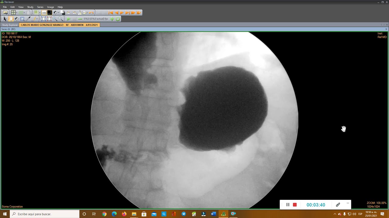 Radiografía Completa de vías digestivas Esófago - Estomago - Duodeno ...