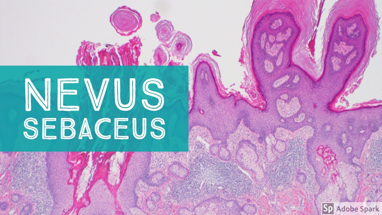 Nevus Sebaceus (not SebaceOus!)...Explained by a Dermatopathologist ...