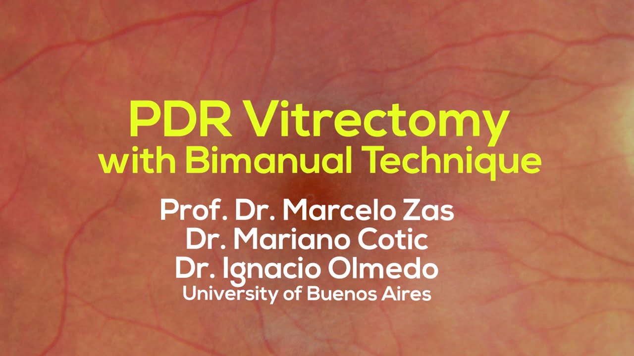 PDR Surgery - Case 2 - YouTube