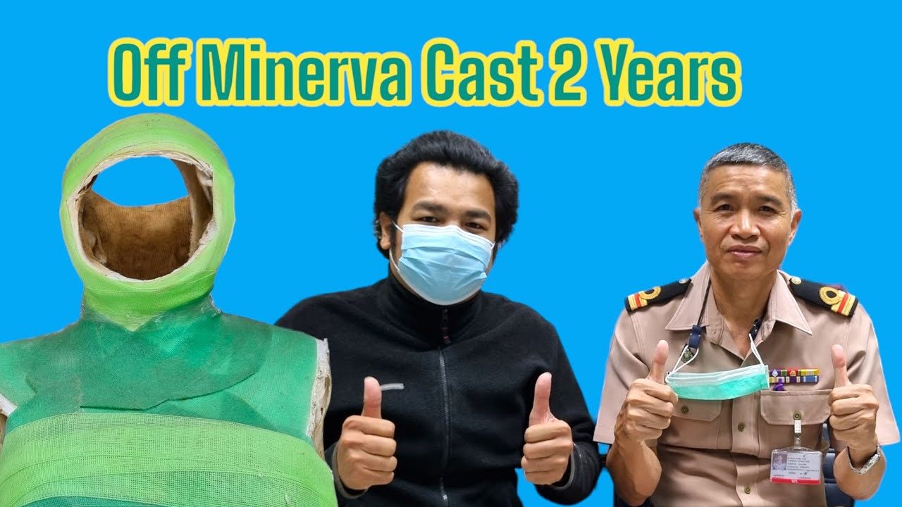 Case Fx. C-spine after take off Minerva Cast 2 years - YouTube