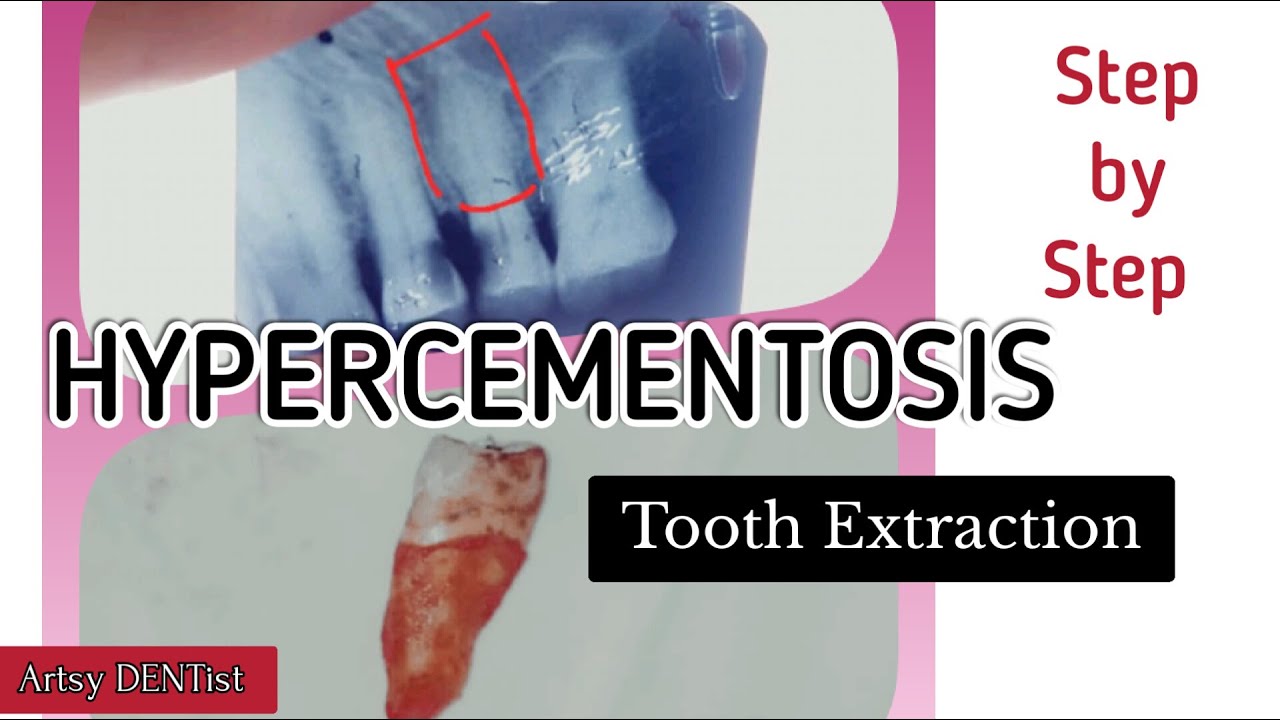 HYPERCEMENTOSIS Tooth Extraction! - YouTube