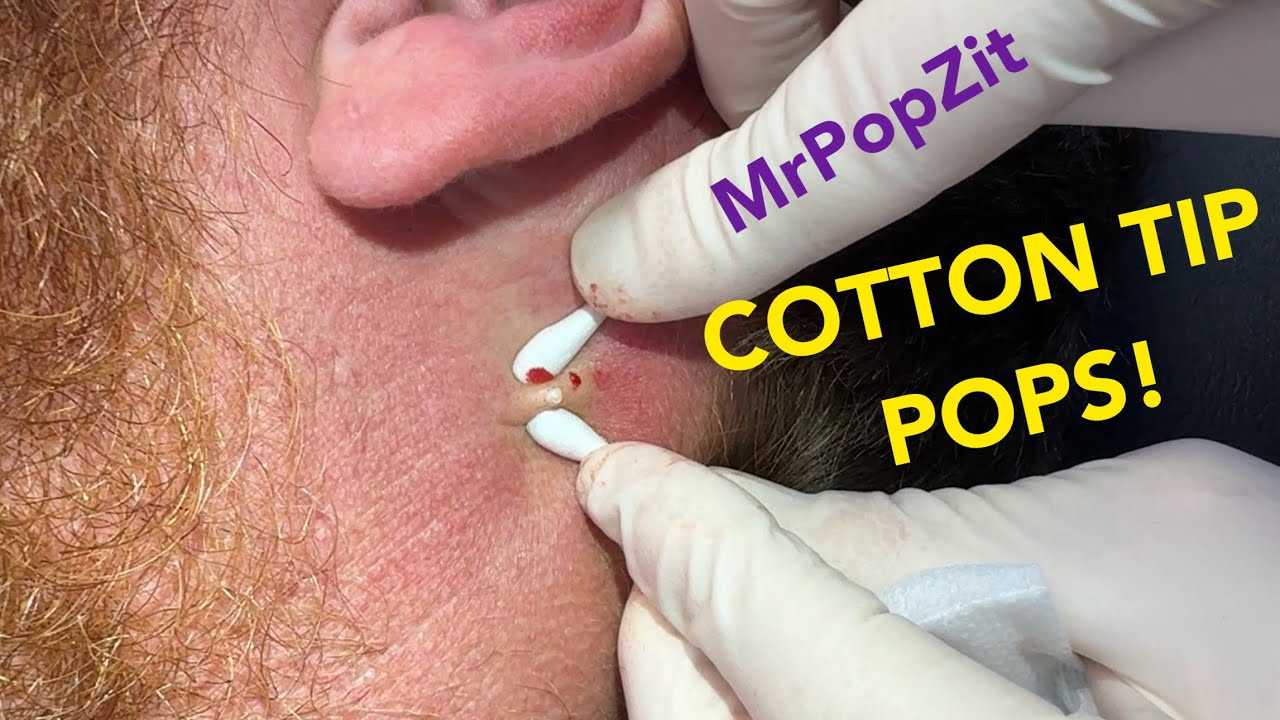 A quick popping session to hold you over! Shallow follicular cysts ...