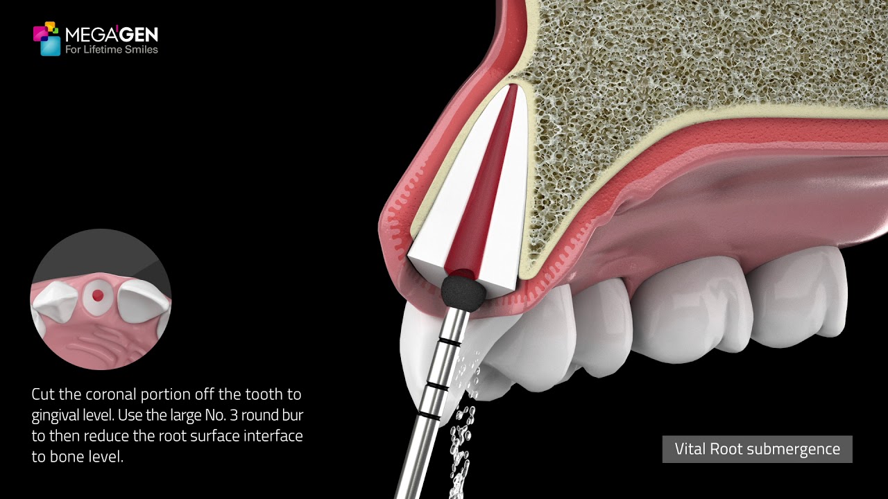 MegaGen PET Kit - Root Submergence technique 1 - YouTube