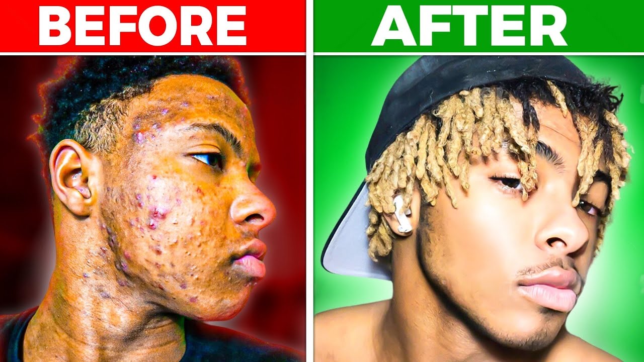 How I Cleared My TERRIBLE Acne (With BAD Genetics) - YouTube