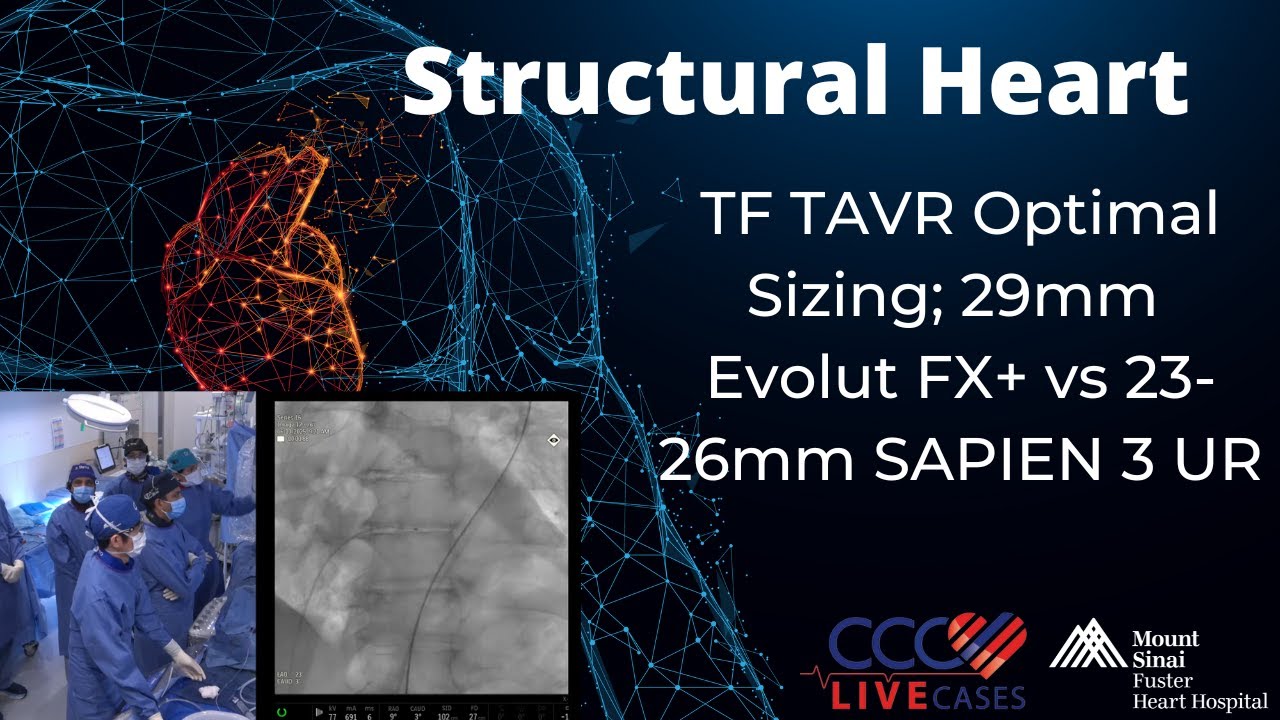 TF TAVR Optimal Sizing; 29mm Evolut FX+vs 23-26mm SAPIEN 3 UR - YouTube
