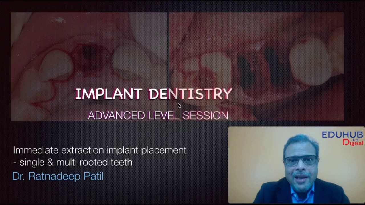 Immediate Extraction implant placement single & Multi rooted teeth ...
