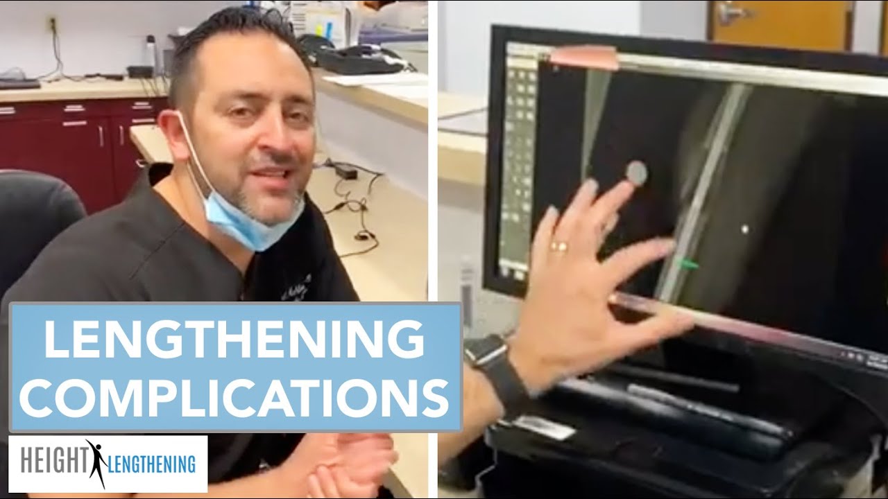 How We Identify & Fix Complications from Leg Lengthening Surgery | Dr ...
