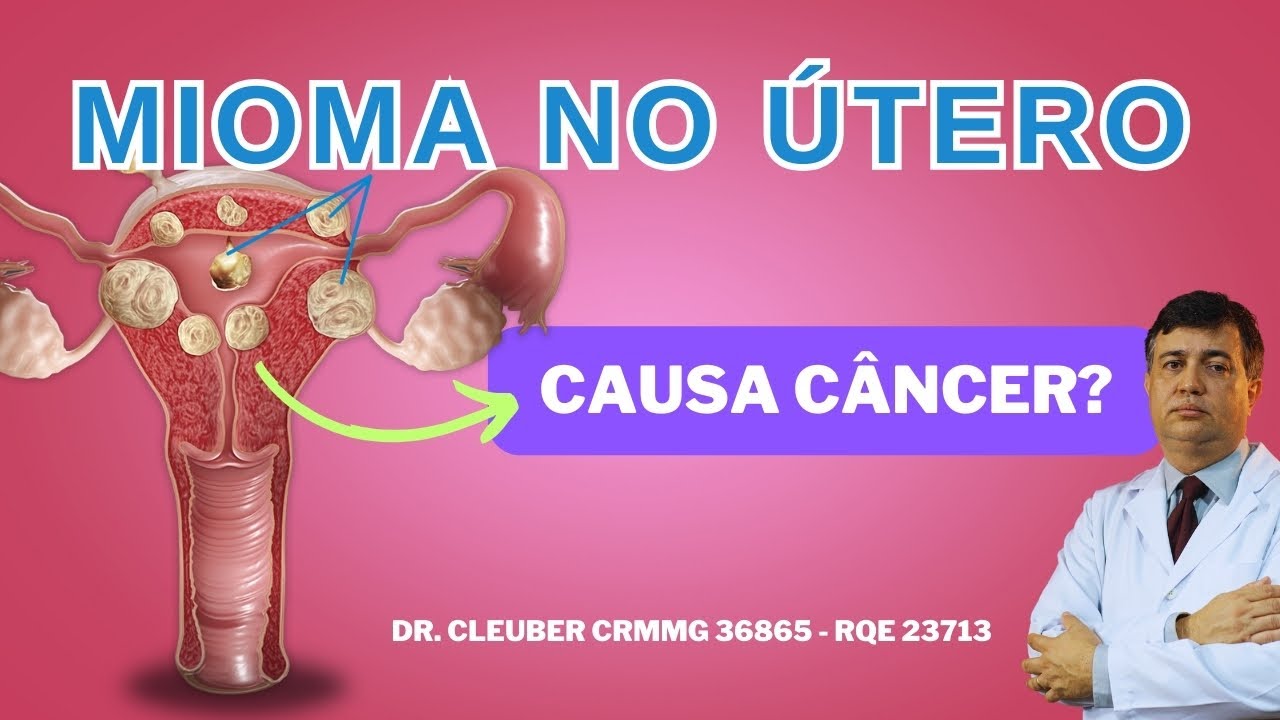 Mioma no Útero causa CÂNCER? ⚠️ Saiba dos Riscos e Sintomas. - YouTube