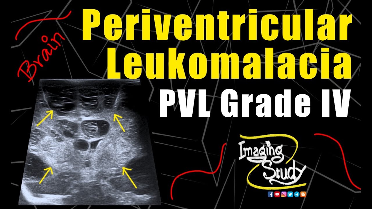 Periventricular Leukomalacia Grade IV || Ultrasound || Case 146 - YouTube