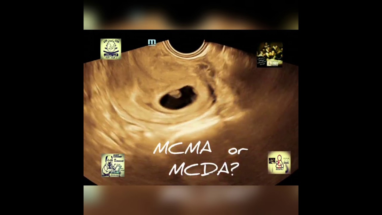 MCMA twins or MCDA twins - YouTube