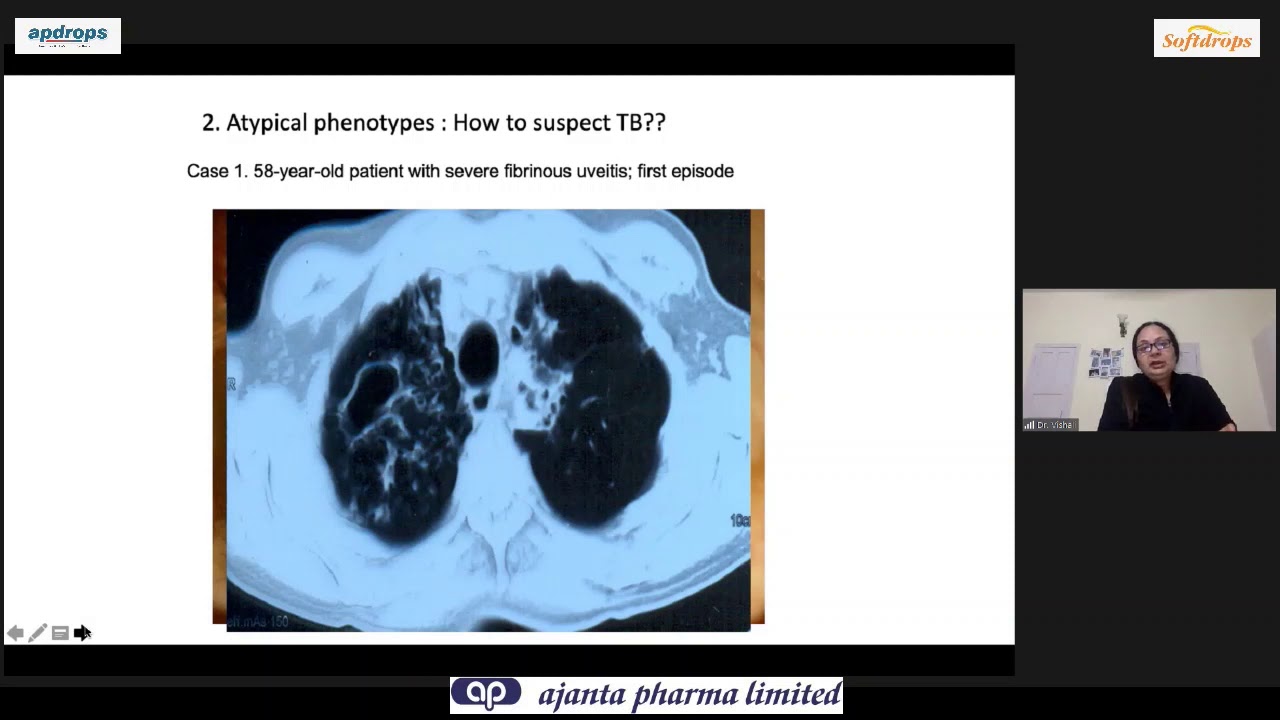 Ocular Tuberculosis- Dr. Vishali Gupta - YouTube