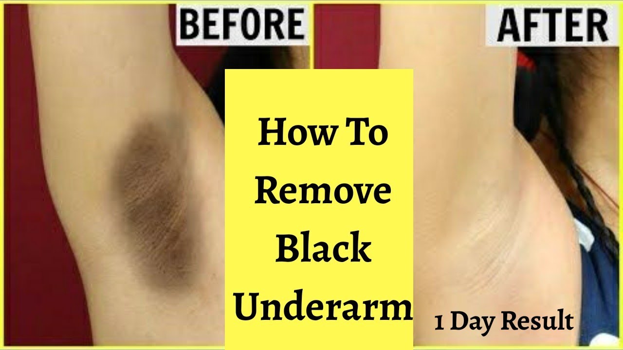 How to lighten dark underarms with this simple home remedy.ll # ...