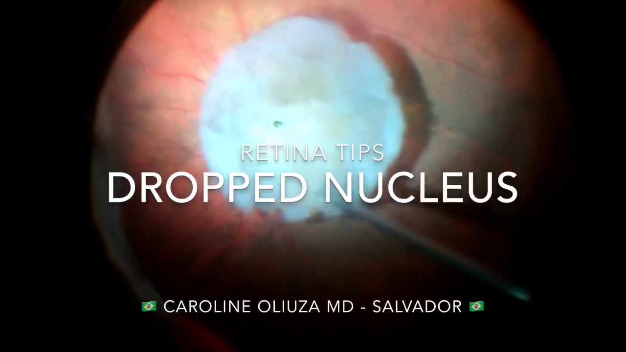 Dropped nucleus - Author: Caroline Oliuza MD - YouTube