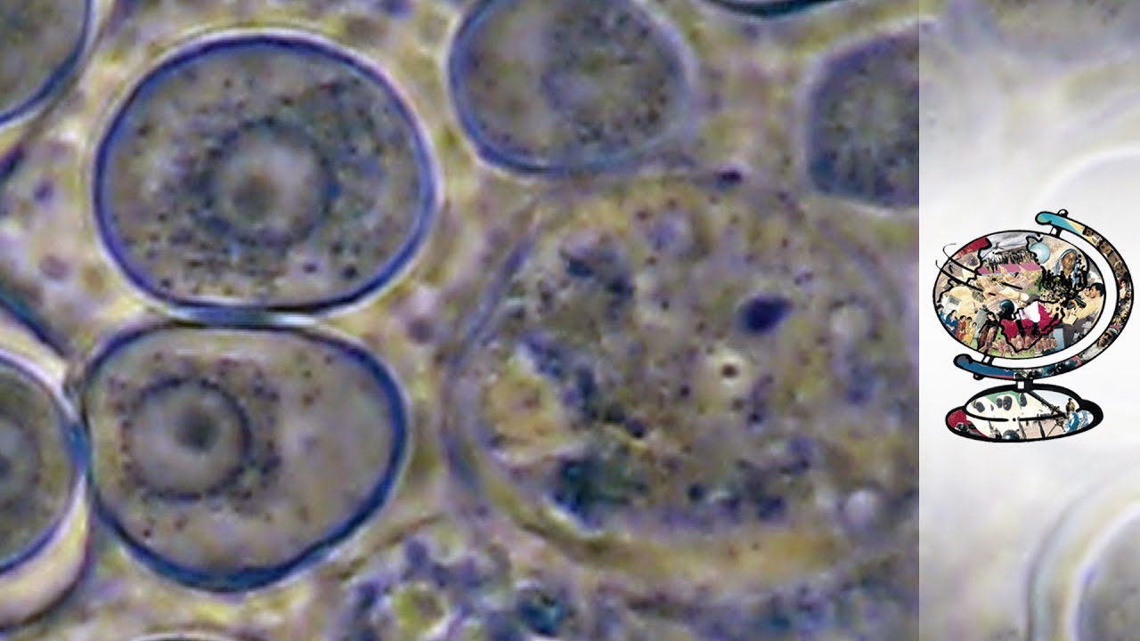 Melioidosis On The Rise In Northern Australia - YouTube