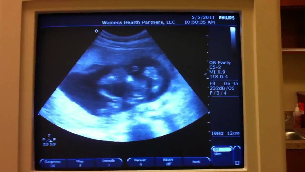 Baby Sonogram 16 Weeks Twins - YouTube