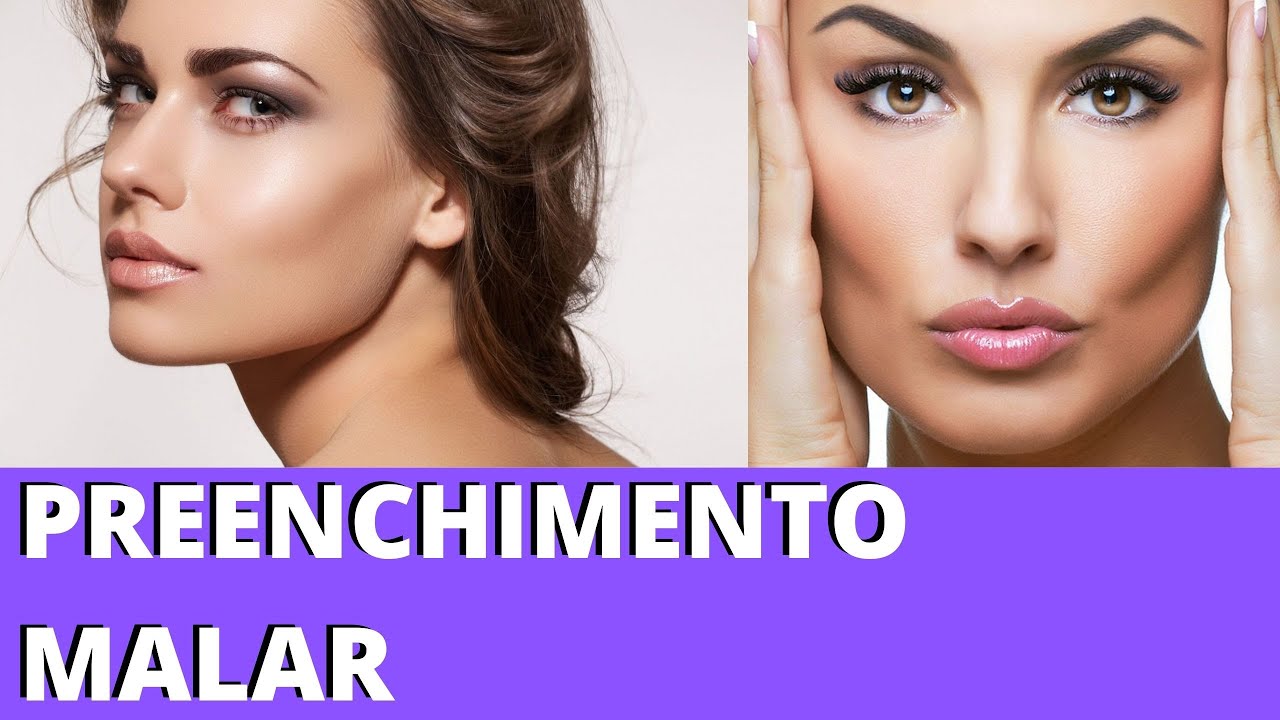 PREENCHIMENTO MALAR: Veja o Antes e Depois - YouTube