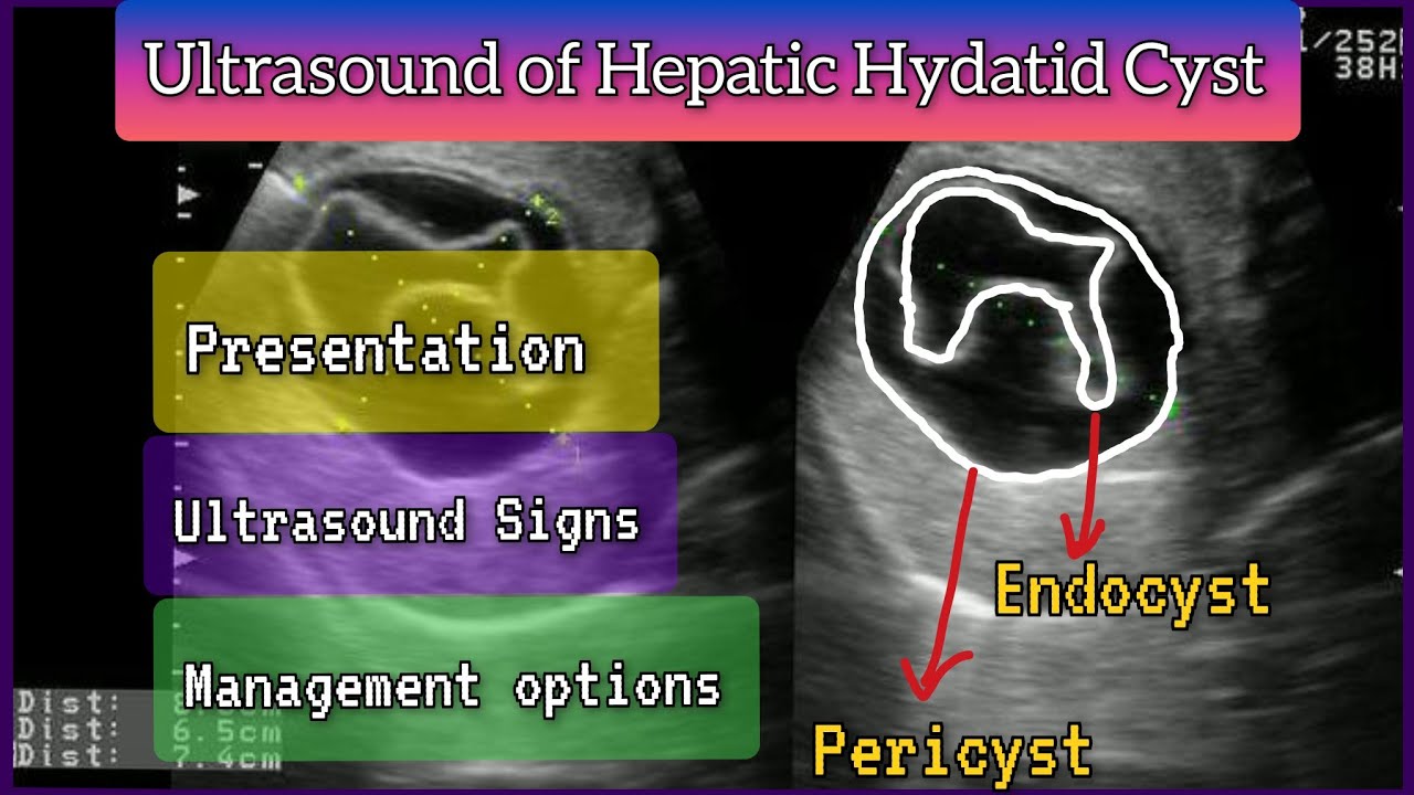 What is Hydatid Cyst? how to diagnose? #ultrasound #medical #disease #treatment #hospital # ...