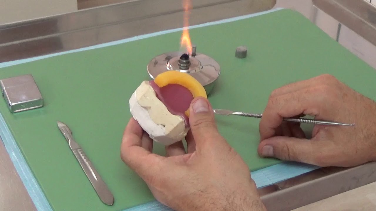 Colocación rodete cera para registro de oclusión completa superior ...
