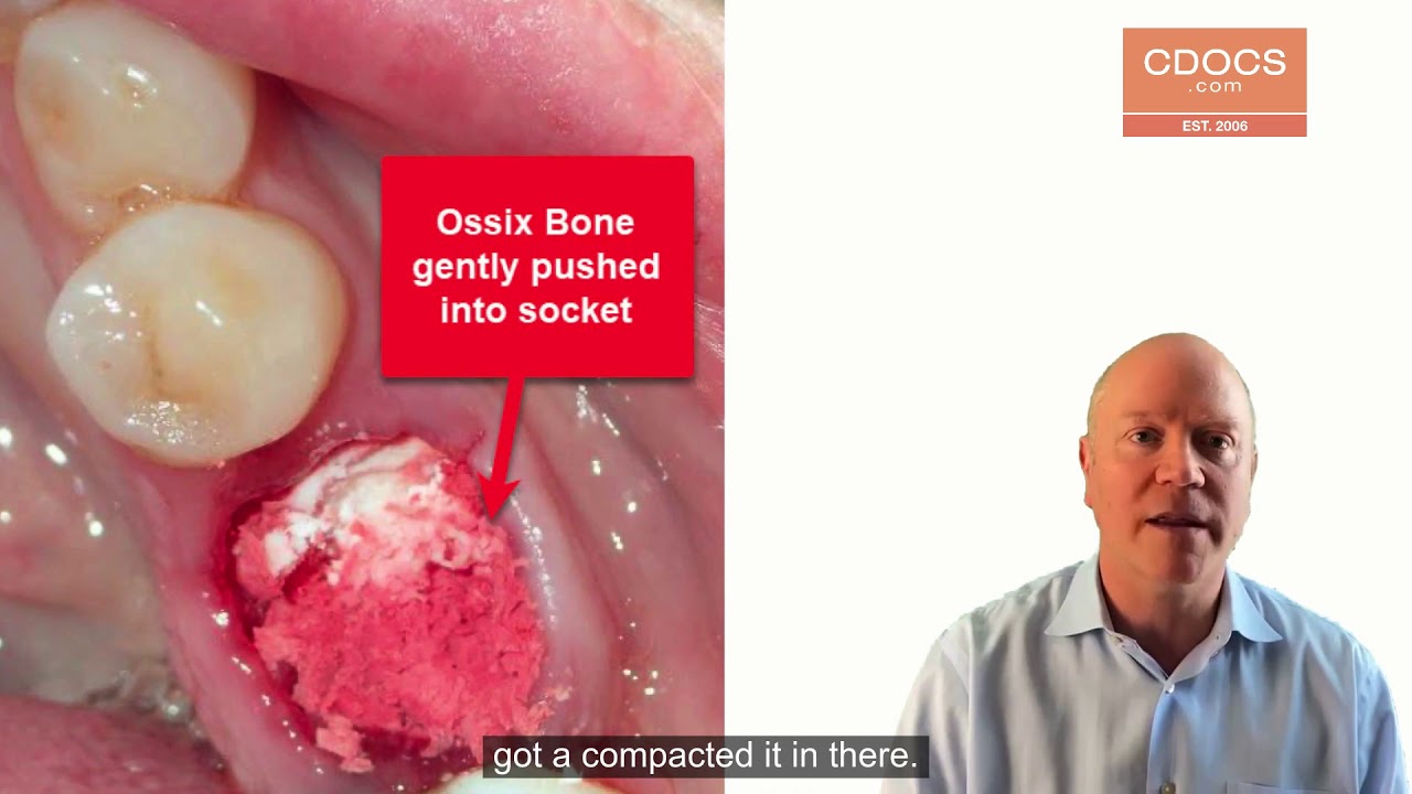 Tip of the Day: Socket Grafting Suturing - YouTube