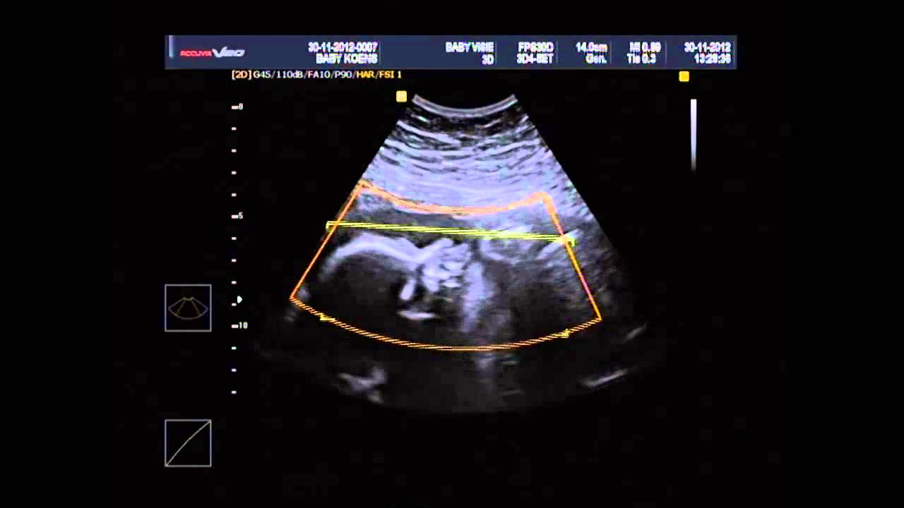 4D Echo Baby - Koens Fernandez - YouTube