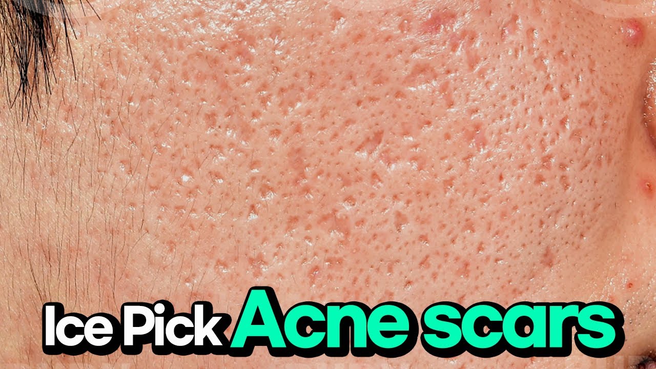 Deep Acne Scars Solved: Ice Pick Scar Laser Treatment Explained - YouTube
