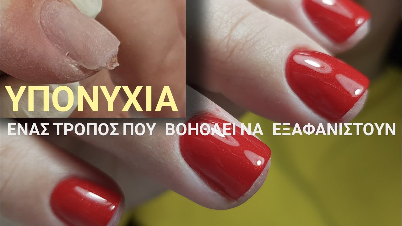 Υπονυχια/Αντιμετωπιζουμε το προβλημα/Πως να τα εξαφανισουμε - YouTube