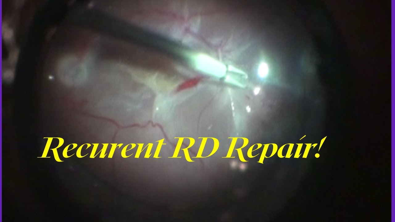 Recurrent retinal detachment repair! - YouTube