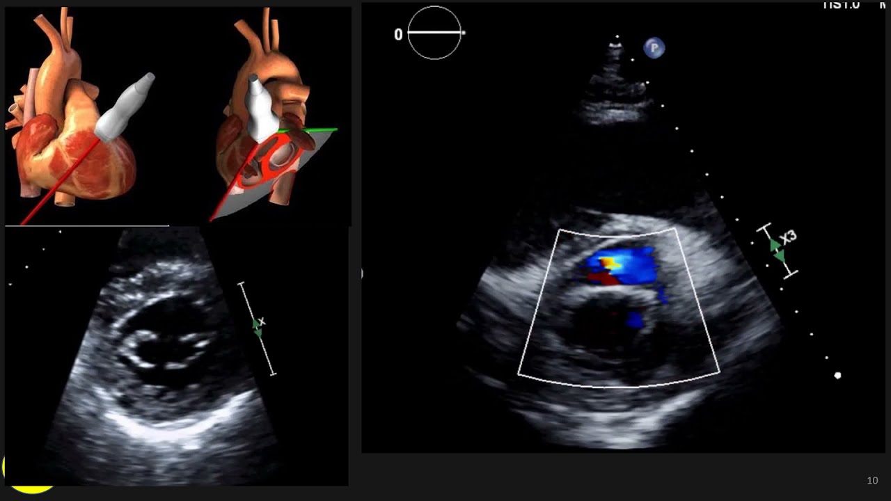 Echocardiographic anatomy Part 2: PSAX (Short axis) - YouTube