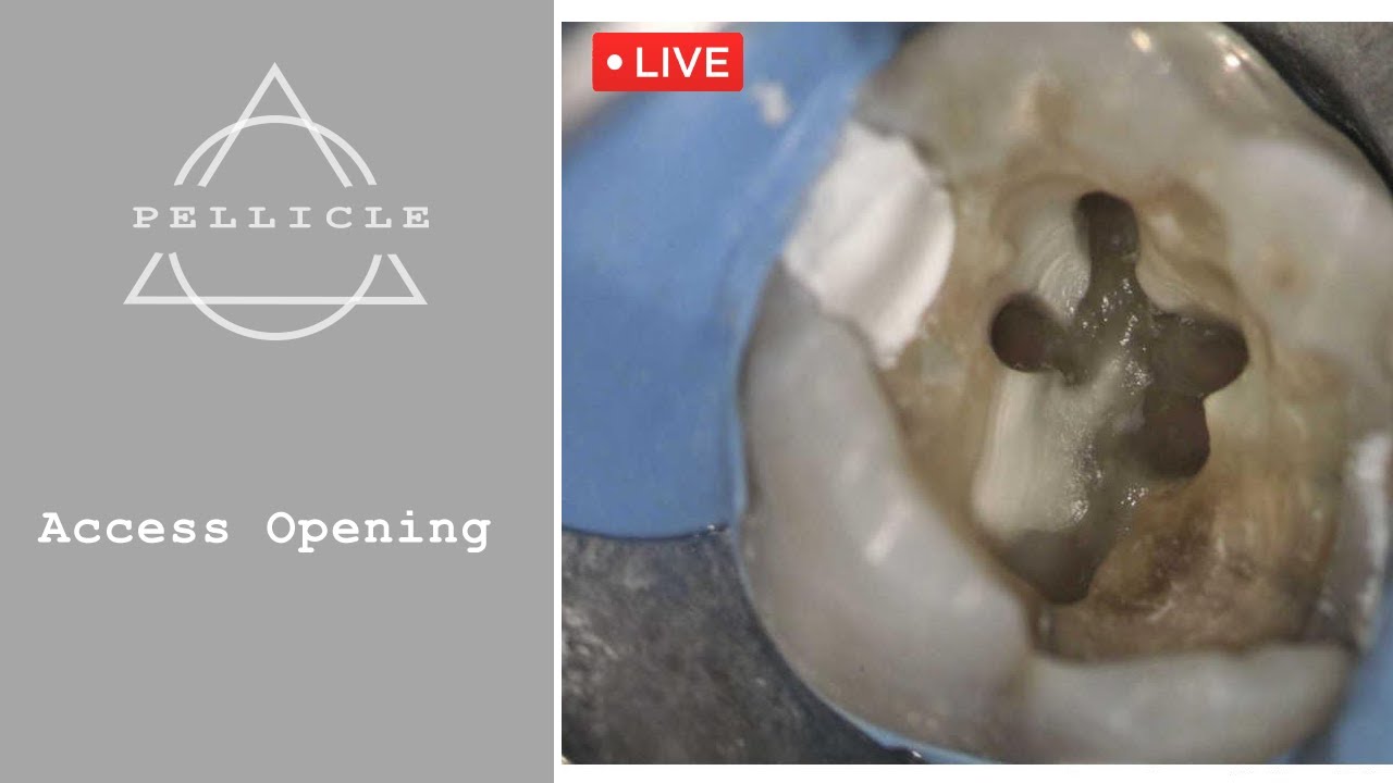 Access Opening - YouTube