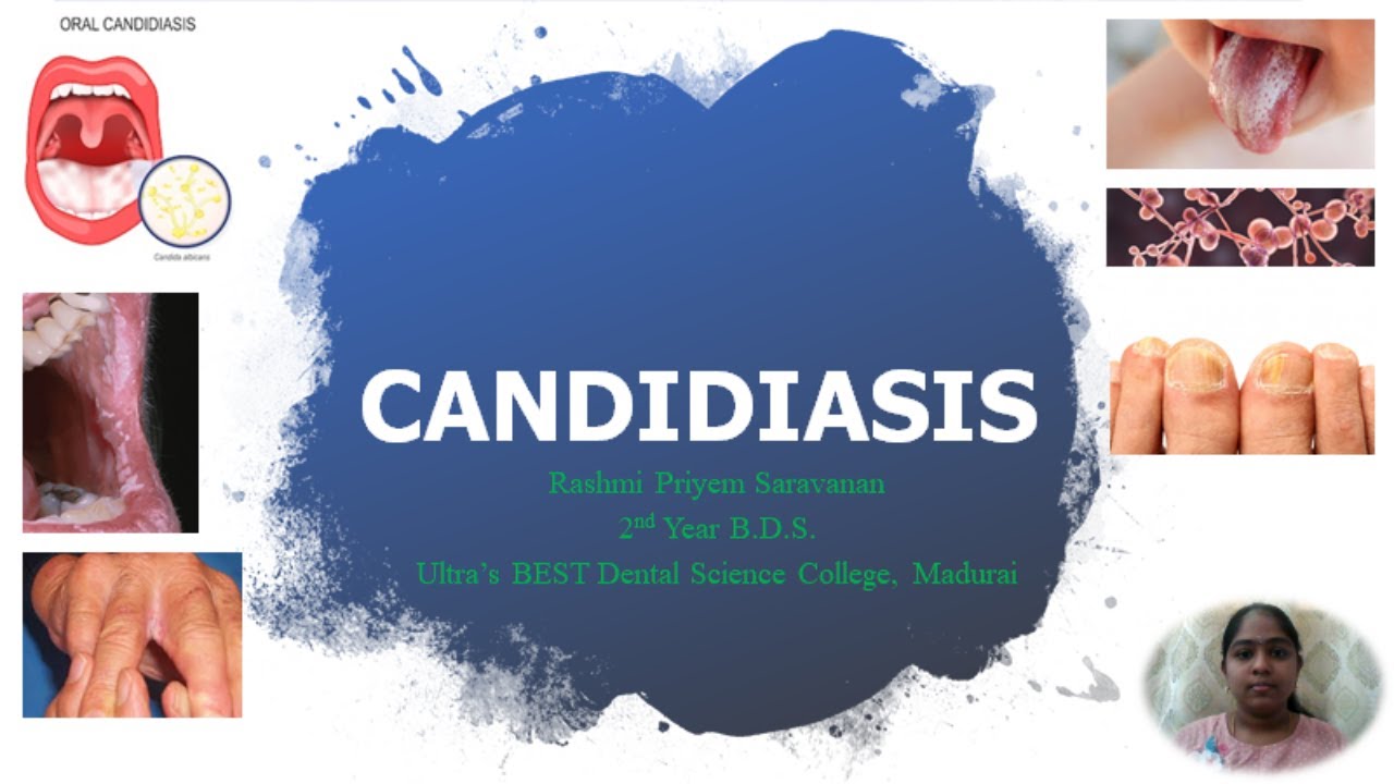 Candidiasis | Candida albicans | Pathogenesis | Clinical Manifestations ...