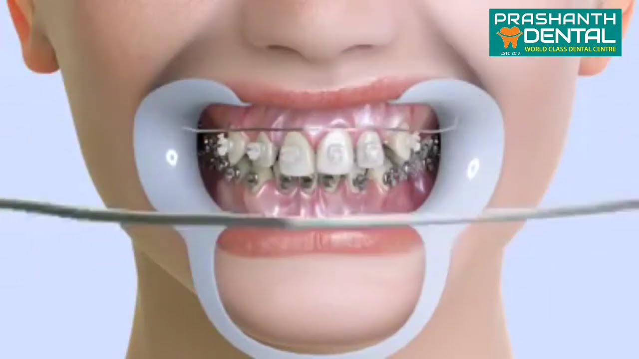 How braces works - YouTube