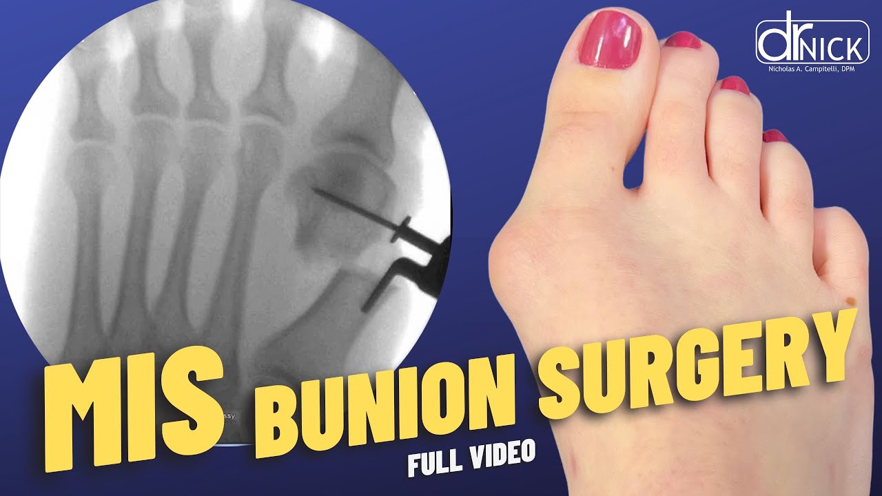 Tiny Incision, Big Fix: Bunion Surgery You Won’t Believe - YouTube