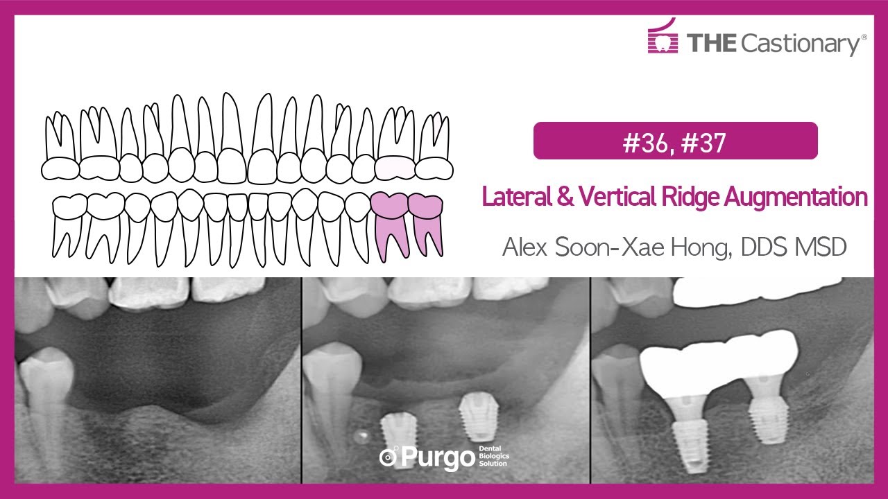 [#36, 37] Lateral & Vertical Ridge Augmentation - YouTube