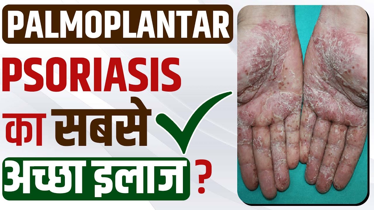 Palmoplantar Psoriasis क्या होता है? | Treatment of Palmoplantar ...