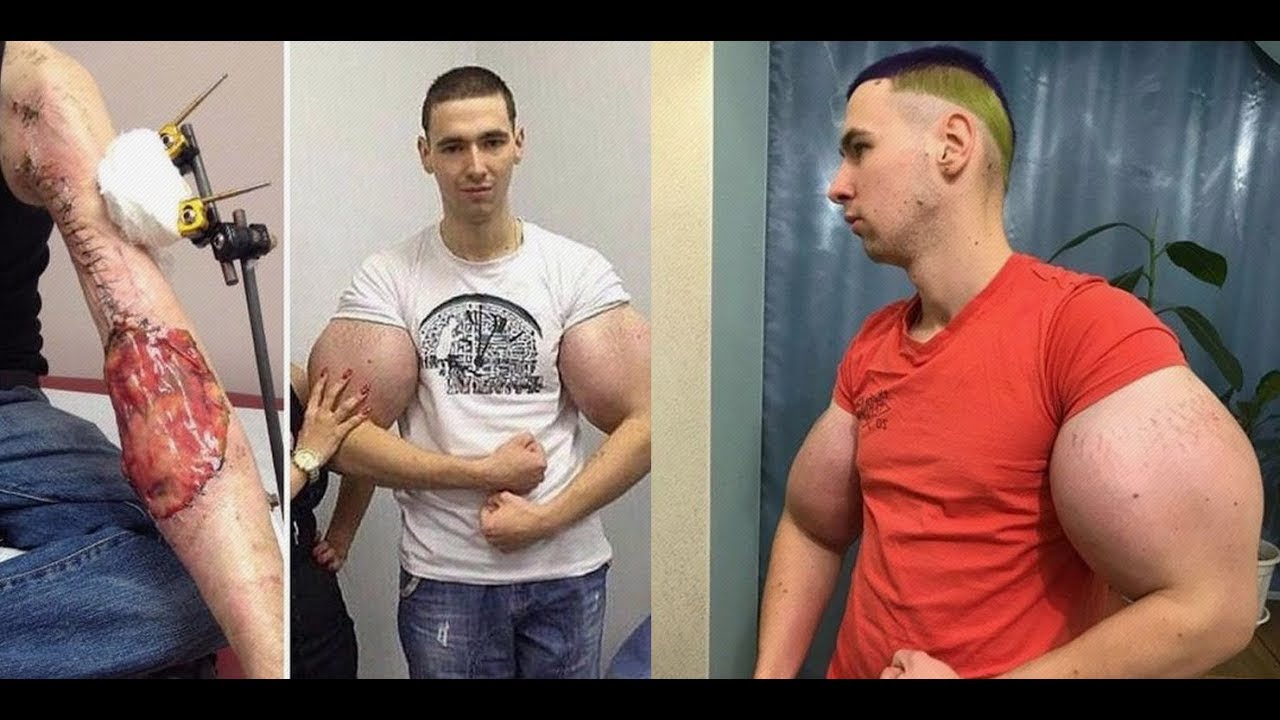 Russian Synthol Freak ! - YouTube