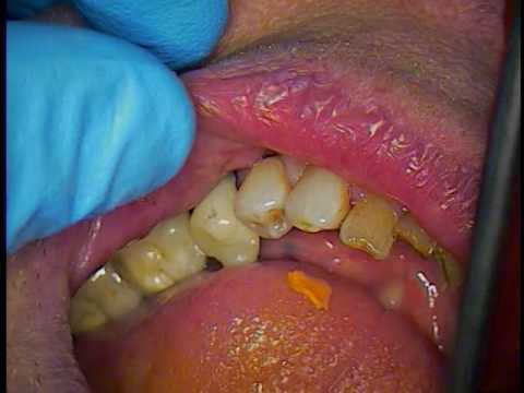Crown preparation with buildup - mandibular left second permanent ...