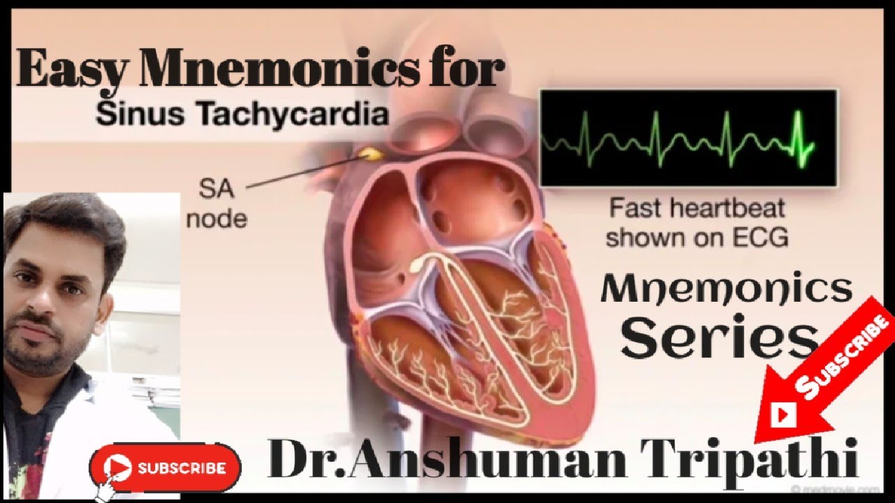 Easy Mnemonics for memorizing " Causes of Sinus Tachycardia" l ...