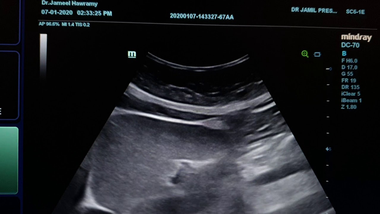 Hepatic Fnh Vs Adenoma Ultrasound Youtube