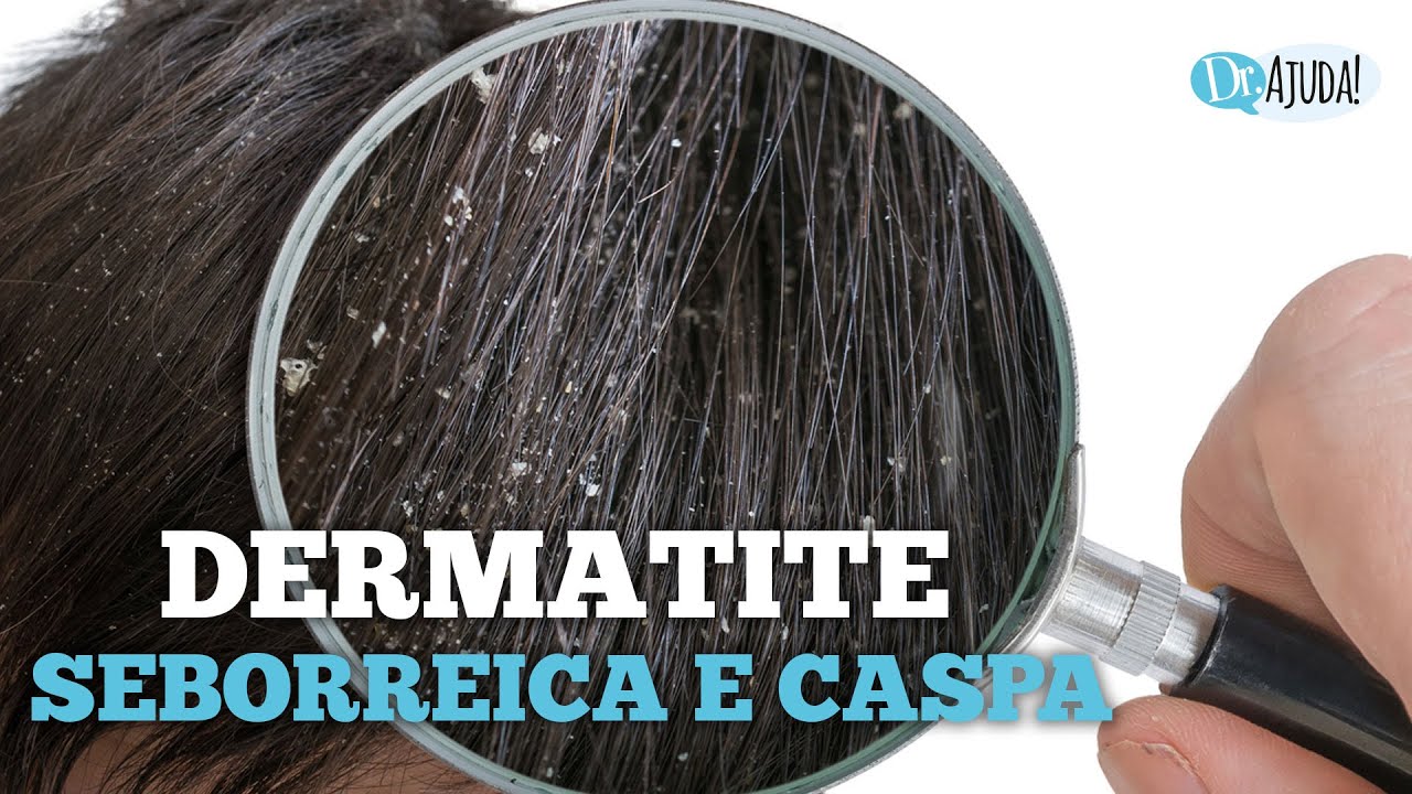 DERMATITE SEBORREICA E CASPA: QUAIS SÃO AS CAUSAS E O QUE FAZER? - YouTube