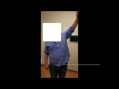 Reverse Shoulder Arthroplasty w/Latissimus Dorsi Tendon Transfer - YouTube