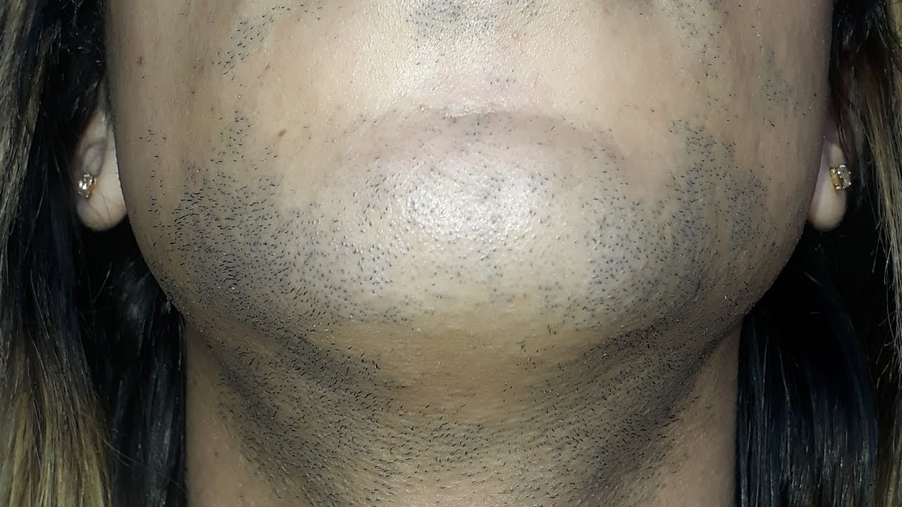 DEPILAÇÃO A LASER BARBA 1° RESULTADO!!! - YouTube