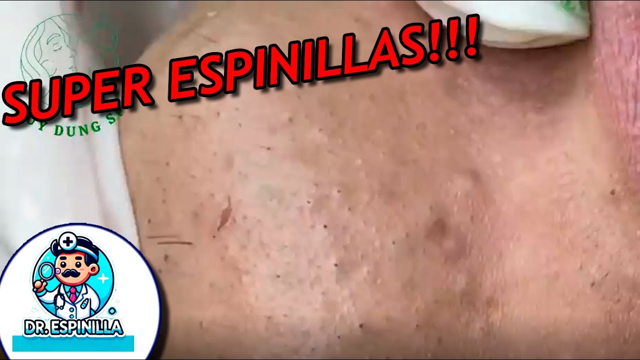 037-Quieres ver la extracción de espinillas? - YouTube