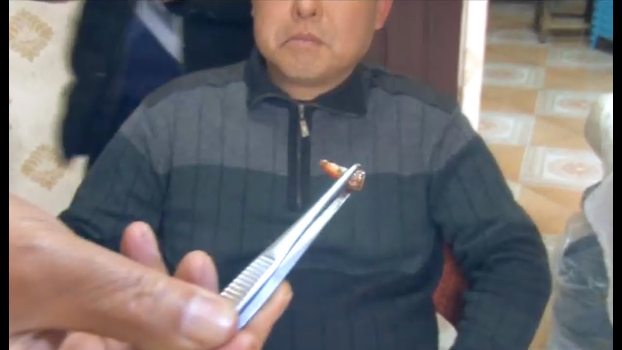 Tooth removal using Psi power - YouTube