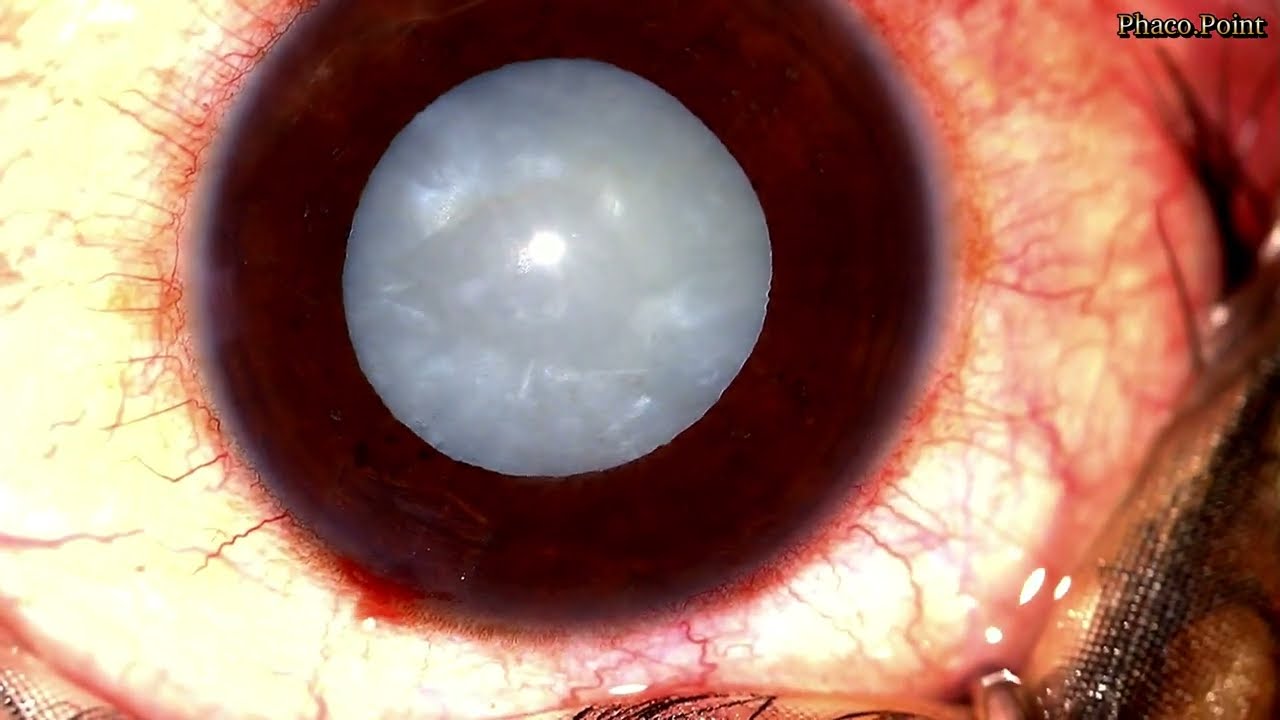 Ripped Rhexis - Intumescent Cataract - Averted Argentinian flag and how ...