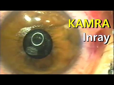 KAMRA Inlay for Presbyopia (Class 2 Device Recall) - YouTube